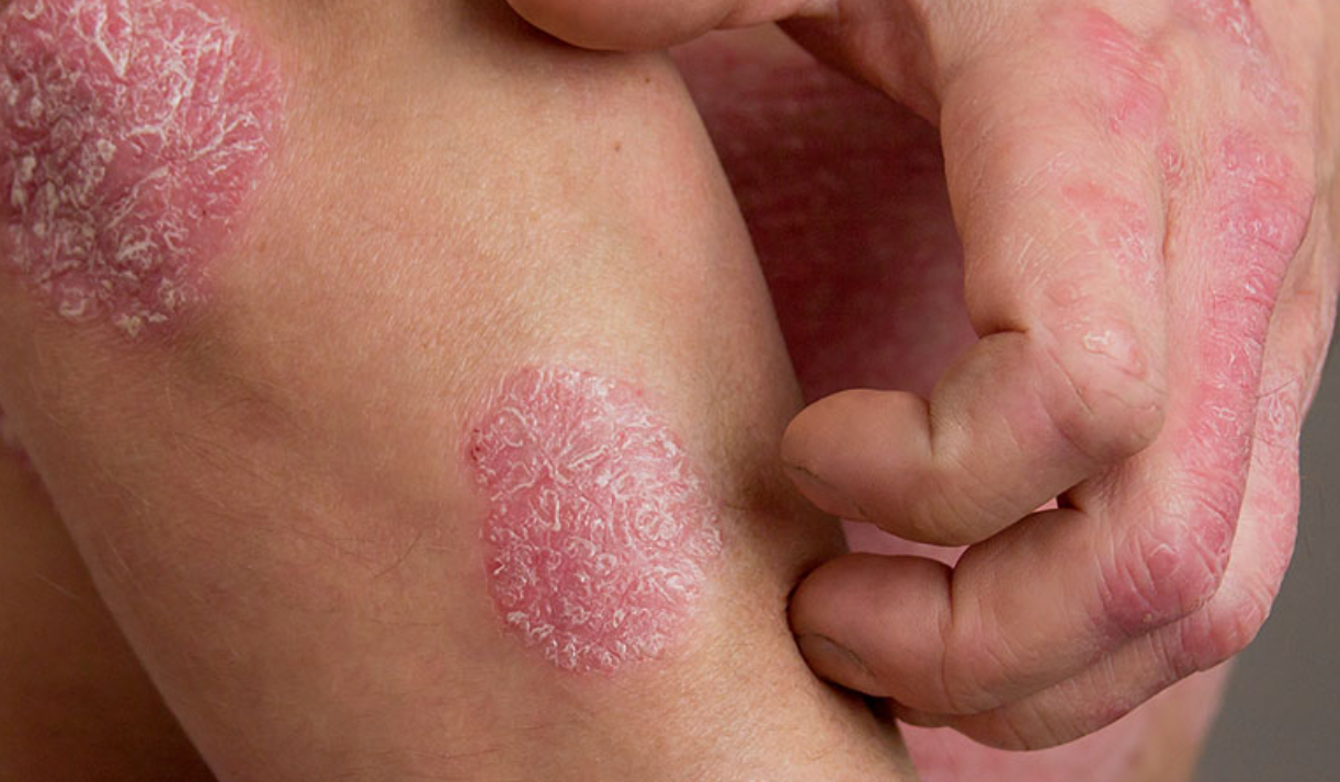 Reishi Mushrooms for Psoriasis – Dr Noel's Mushroom Powder